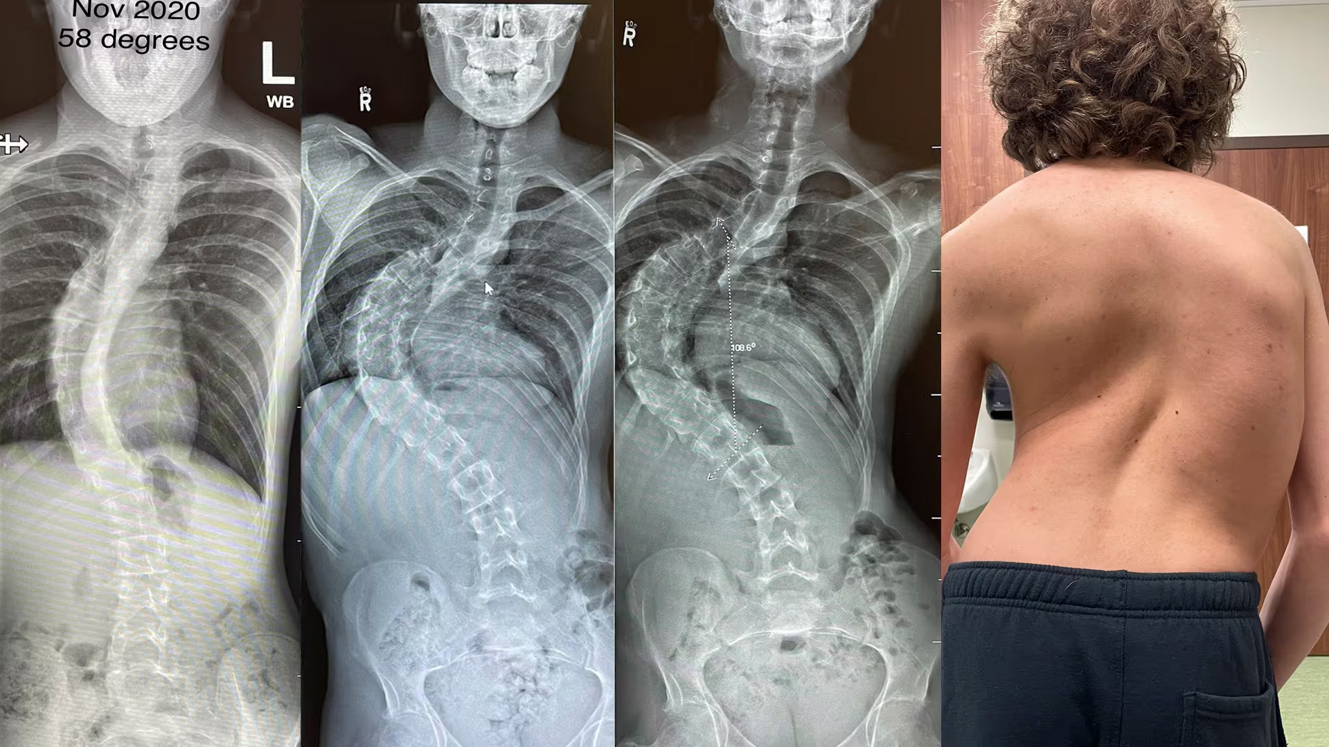 Understanding Spinal Deformities | Dr Gururaj Sangondimath